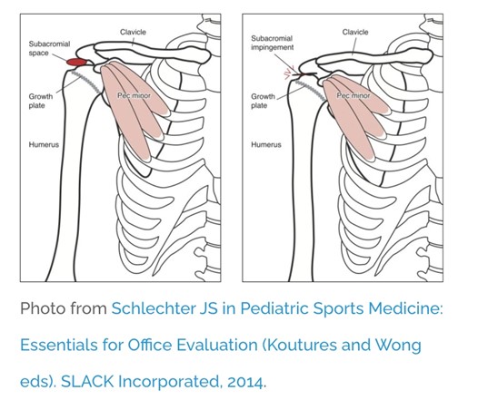 Dr. Chris Koutures: Dealing with volleyball back pain from serving ...